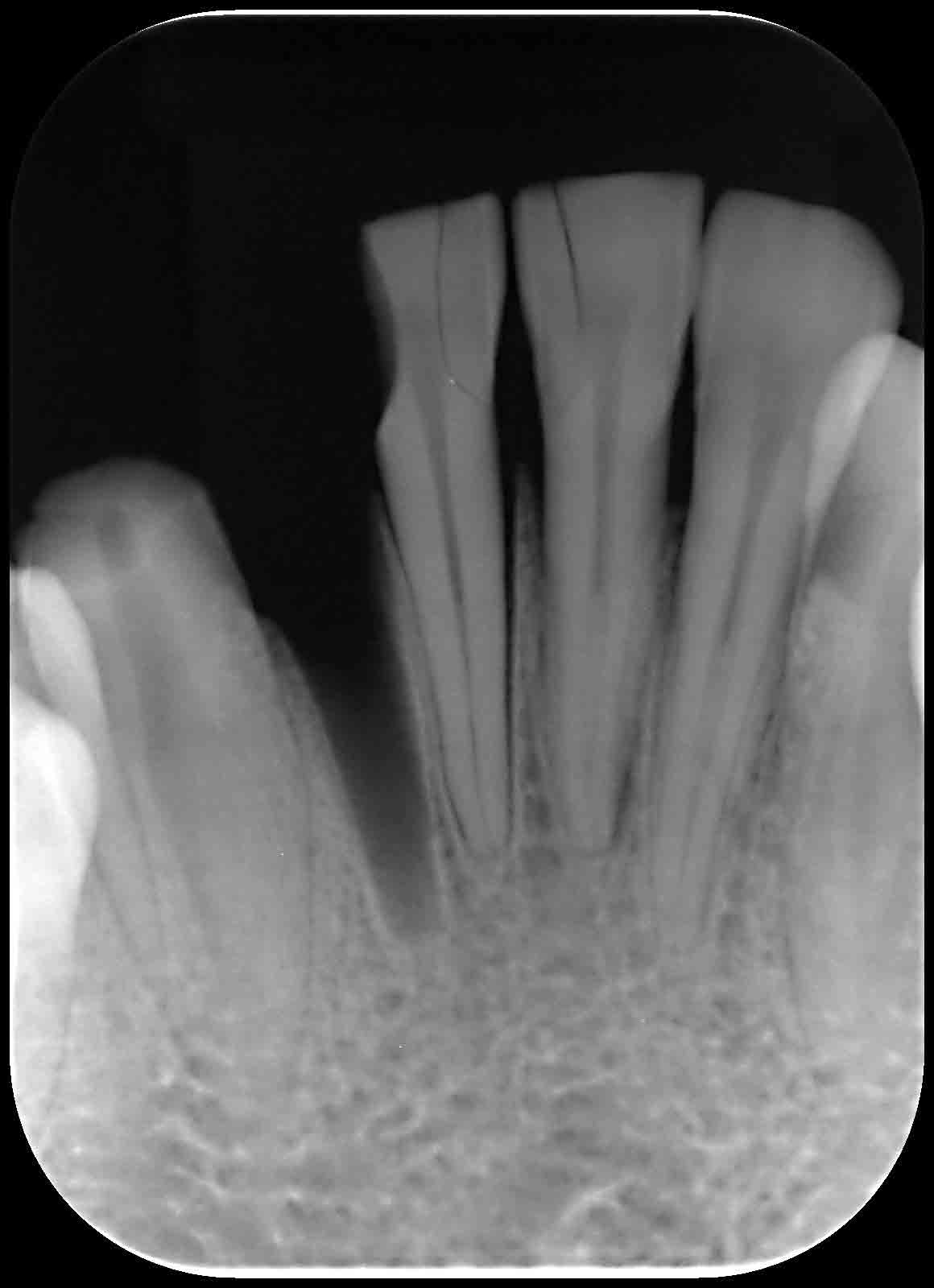 Lower Incisor